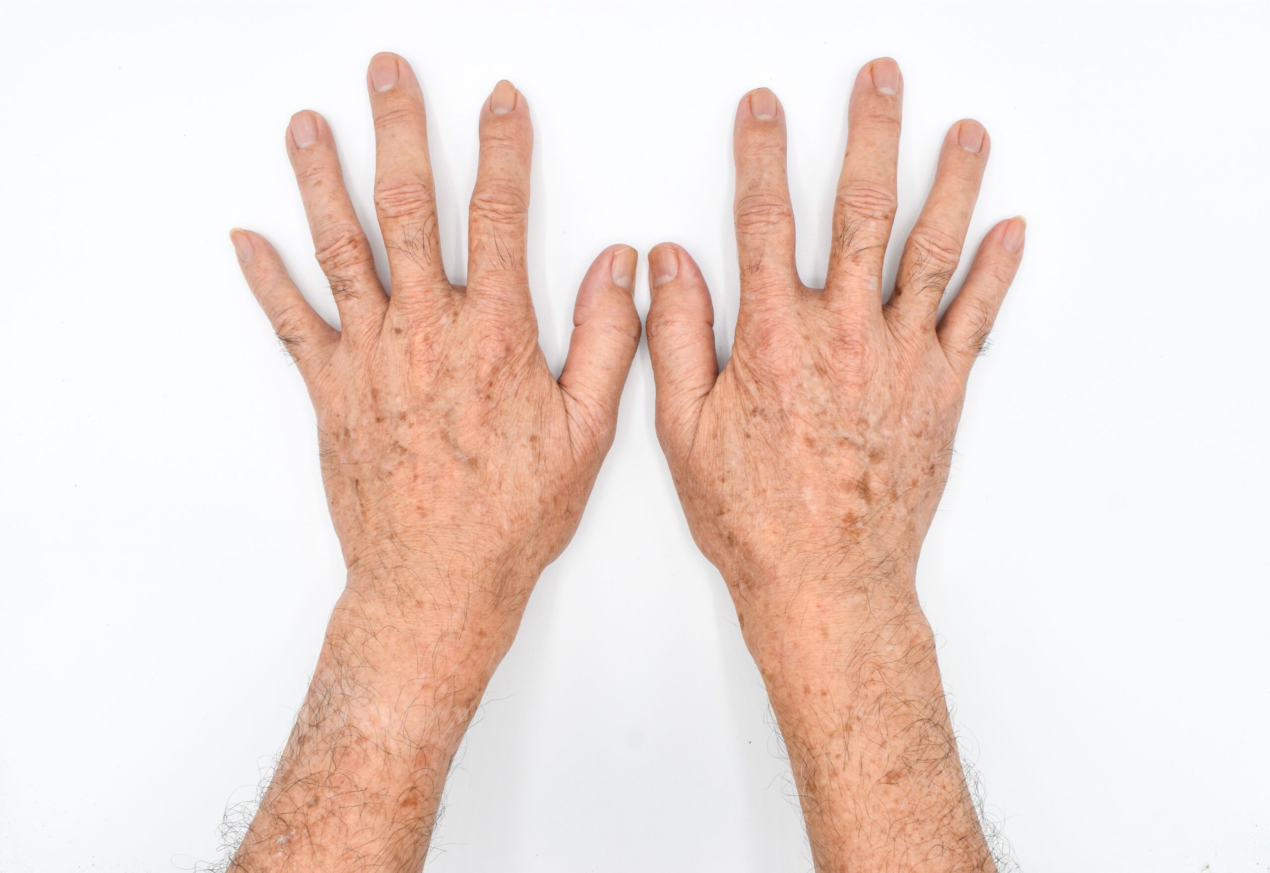 LEUCODERMIA - Clínica Jacob